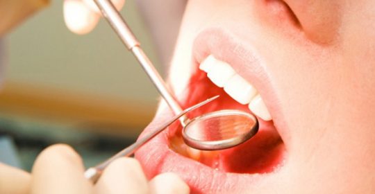 El cálculo dental, también llamado sarro - Clínica dental Alicia Felici